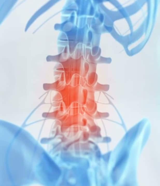 Causes and Treatments of Lumbar Radiculopathy