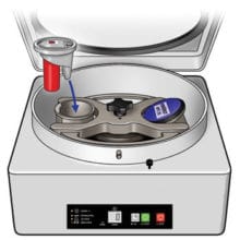 Osteochondral Defect Treatment With PRP Platelet Rich Plasma